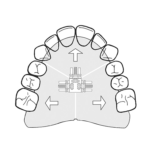 Forestadent Bertoni Multi-Sectional Screws