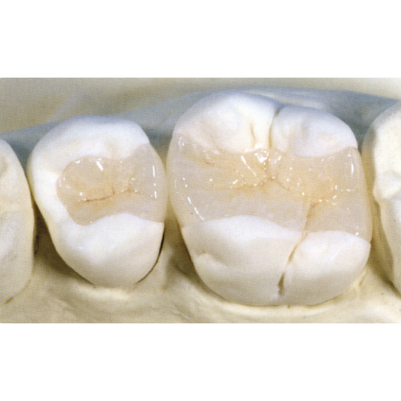 Ivoclar IPS Empress Esthetic Pressed All-Ceramic, EO3