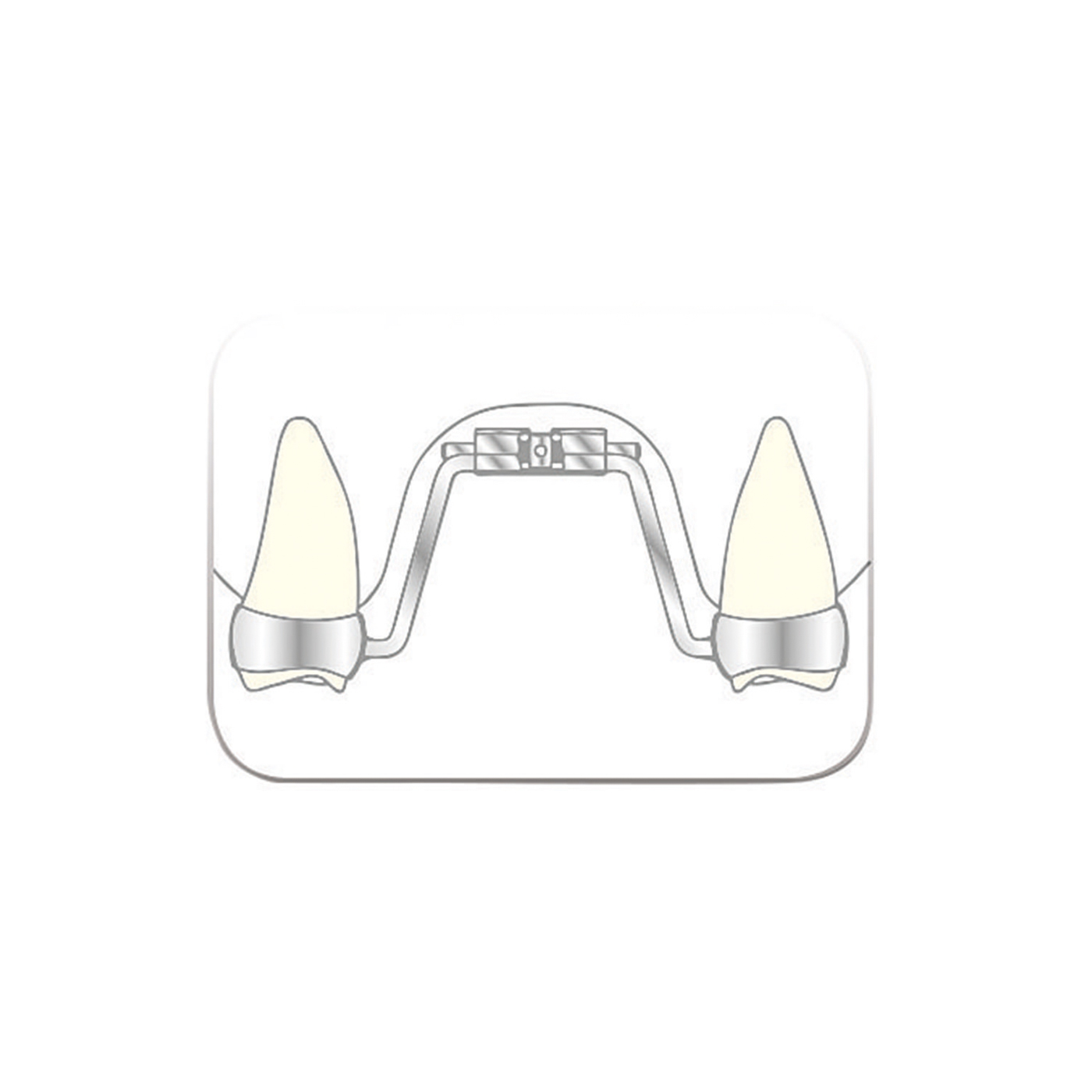 Scheu-Dental Vector 620 Palatal Expansion Screw